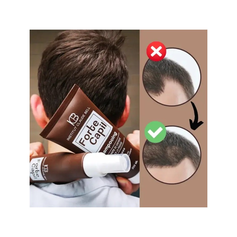 Full Anti-Hair Loss Treatment Routine with Vitamins by FORTE CAPIL